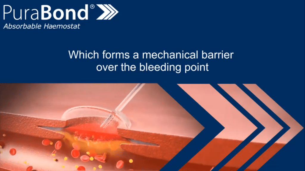 Introducing PuraBond from 3D Matrix – Healthcare21