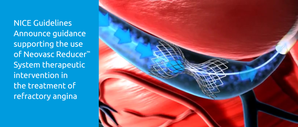 NICE guidelines announce guidance supporting the use of Neovasc Reducer ...